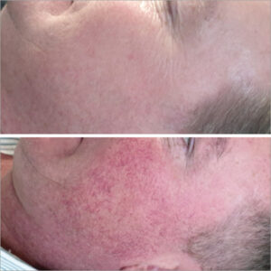 Before & After - Real results - Laser Clinic Galway